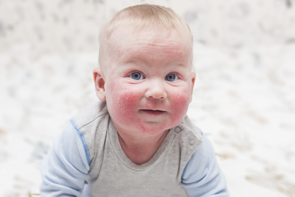 Dermatología Infantil - Yamileth Cruz Dermatóloga